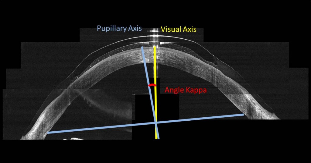 The Key to Success with Duette Progressive: Centration - SynergEyes